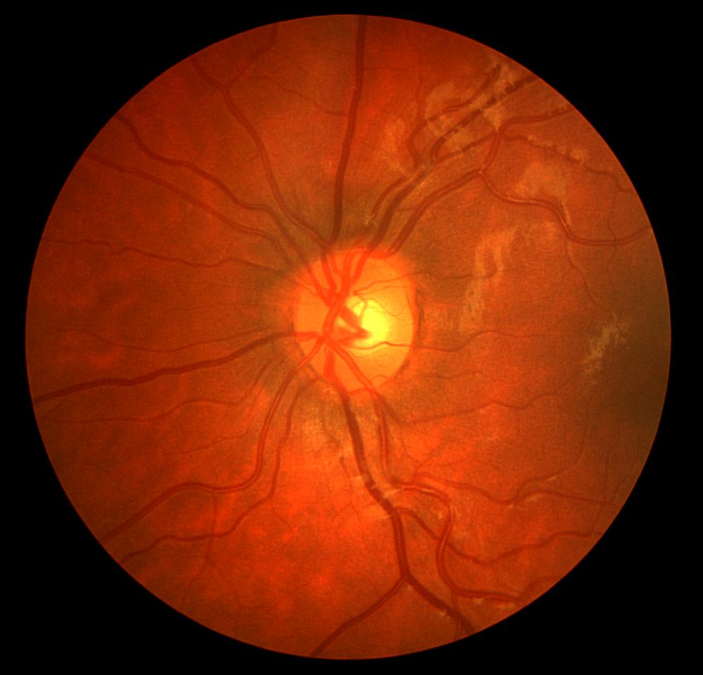 A Two Stage GAN for High Resolution Retinal Image Generation and ...