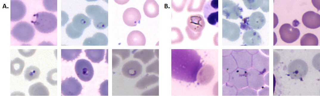 Fully-automated patient-level malaria assessment on field-prepared thin ...