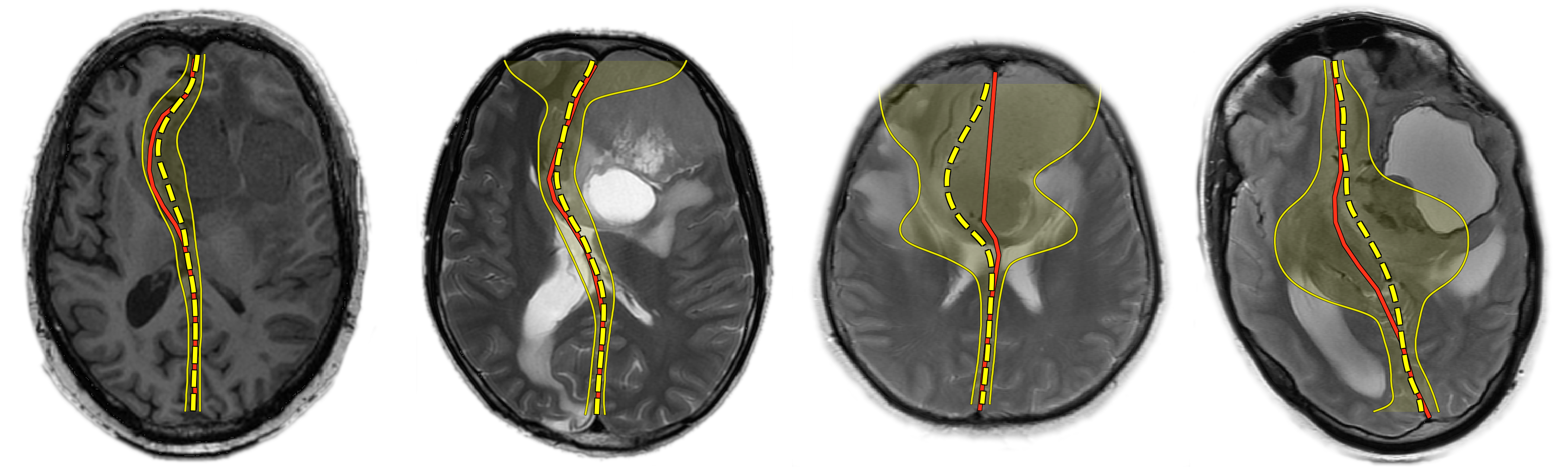 Incorporating Task-Specific Structural Knowledge into CNNs for Brain Midline Shift Detection ...