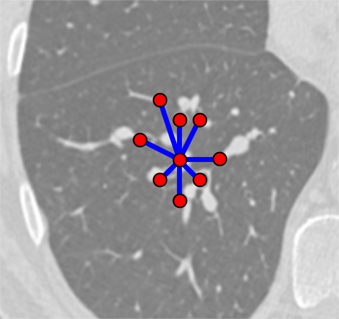 A joint 3D UNet-Graph Neural Network-based method for Airway Segmentation from chest CTs | DeepAI