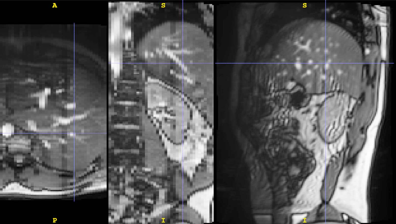 4D MRI: Robust sorting of free breathing MRI slices for use in ...