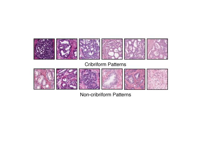 Cribriform pattern detection in prostate histopathological images using ...