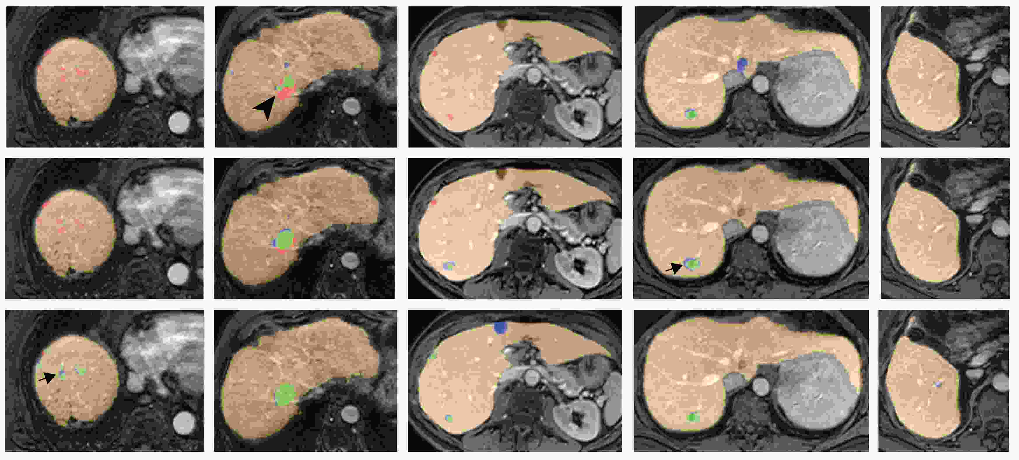 Liver segmentation and metastases detection in MR images using ...