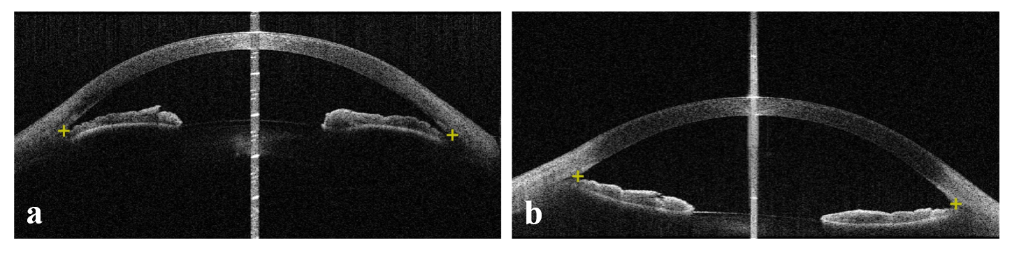 Identification of primary angle-closure on AS-OCT images with ...