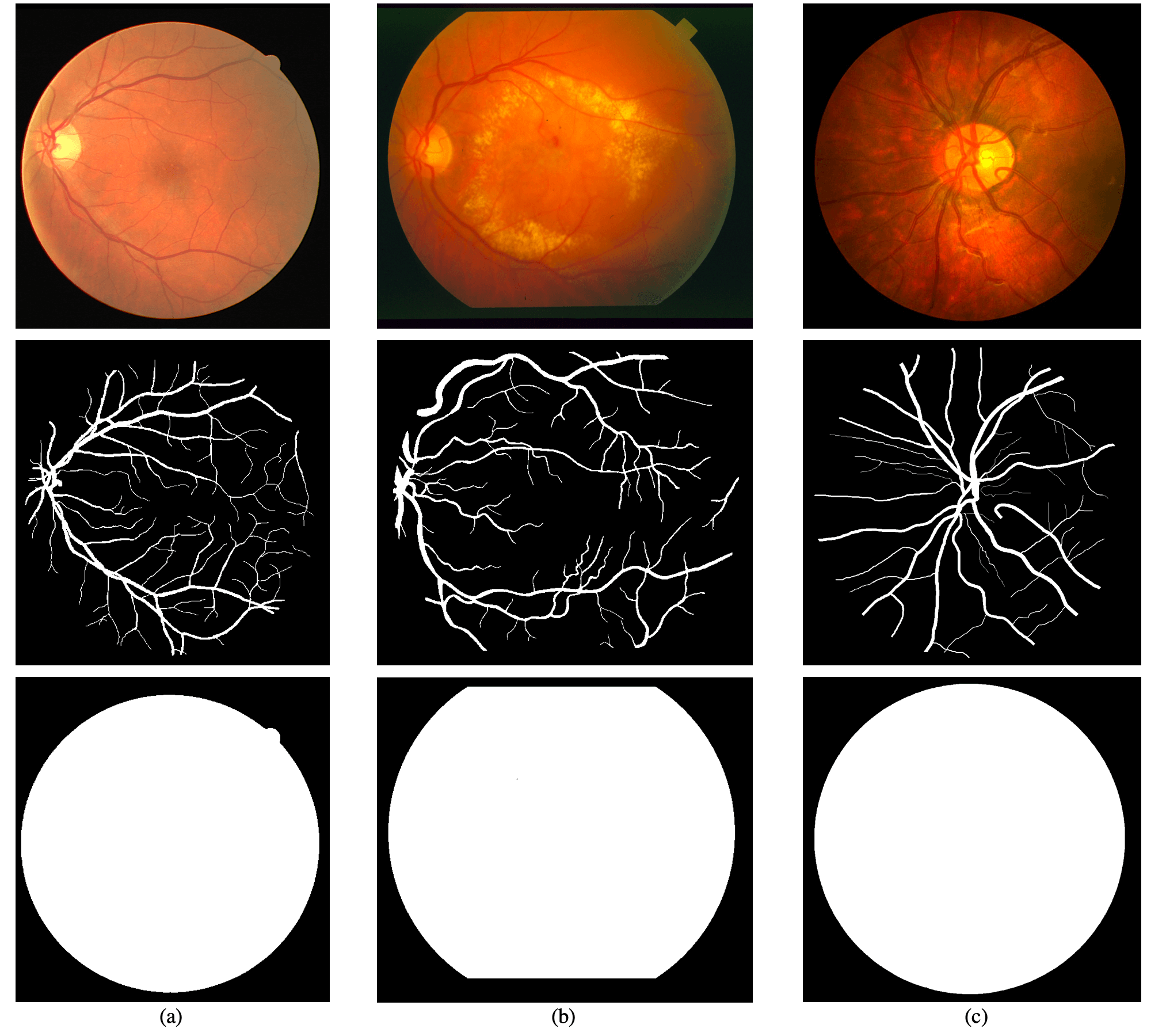 Retinal Vessel Segmentation based on Fully Convolutional Networks | DeepAI