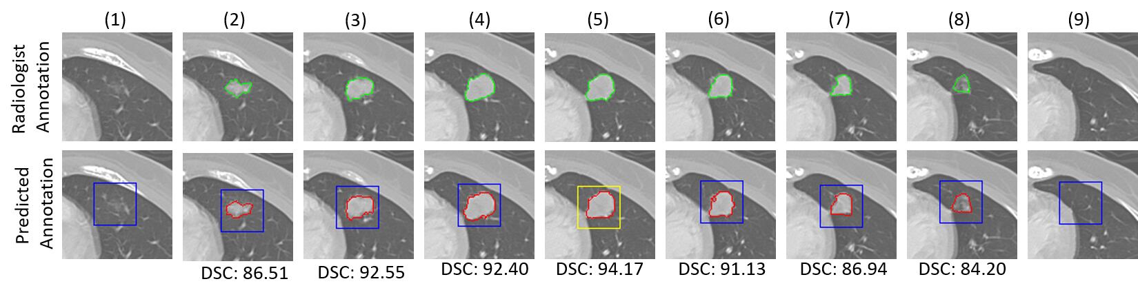 Volumetric Lung Nodule Segmentation using Adaptive ROI with Multi-View Residual Learning | DeepAI