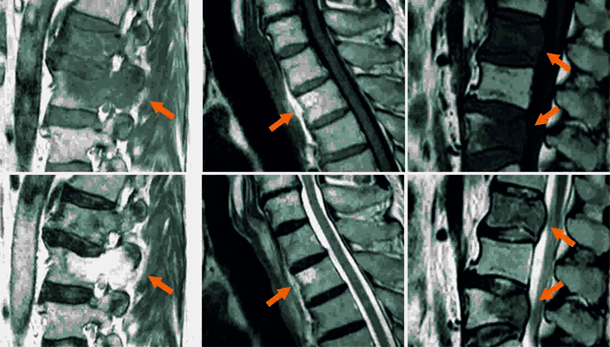 Spinal Metastases Segmentation in MR Imaging using Deep Convolutional ...