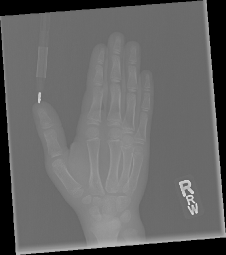 Unsupervised Anomaly Detection for X-Ray Images | DeepAI Unsupervised Anomaly Detection for X-Ray Images | DeepAI