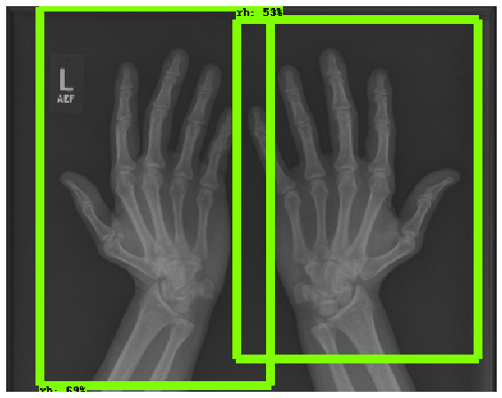 Unsupervised Anomaly Detection for X-Ray Images | DeepAI Unsupervised Anomaly Detection for X-Ray Images | DeepAI