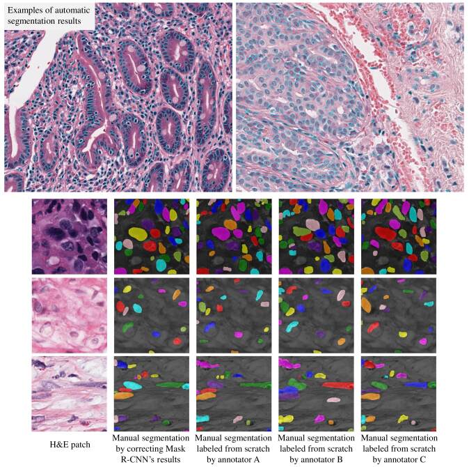 Dataset of Segmented Nuclei in Hematoxylin and Eosin Stained ...