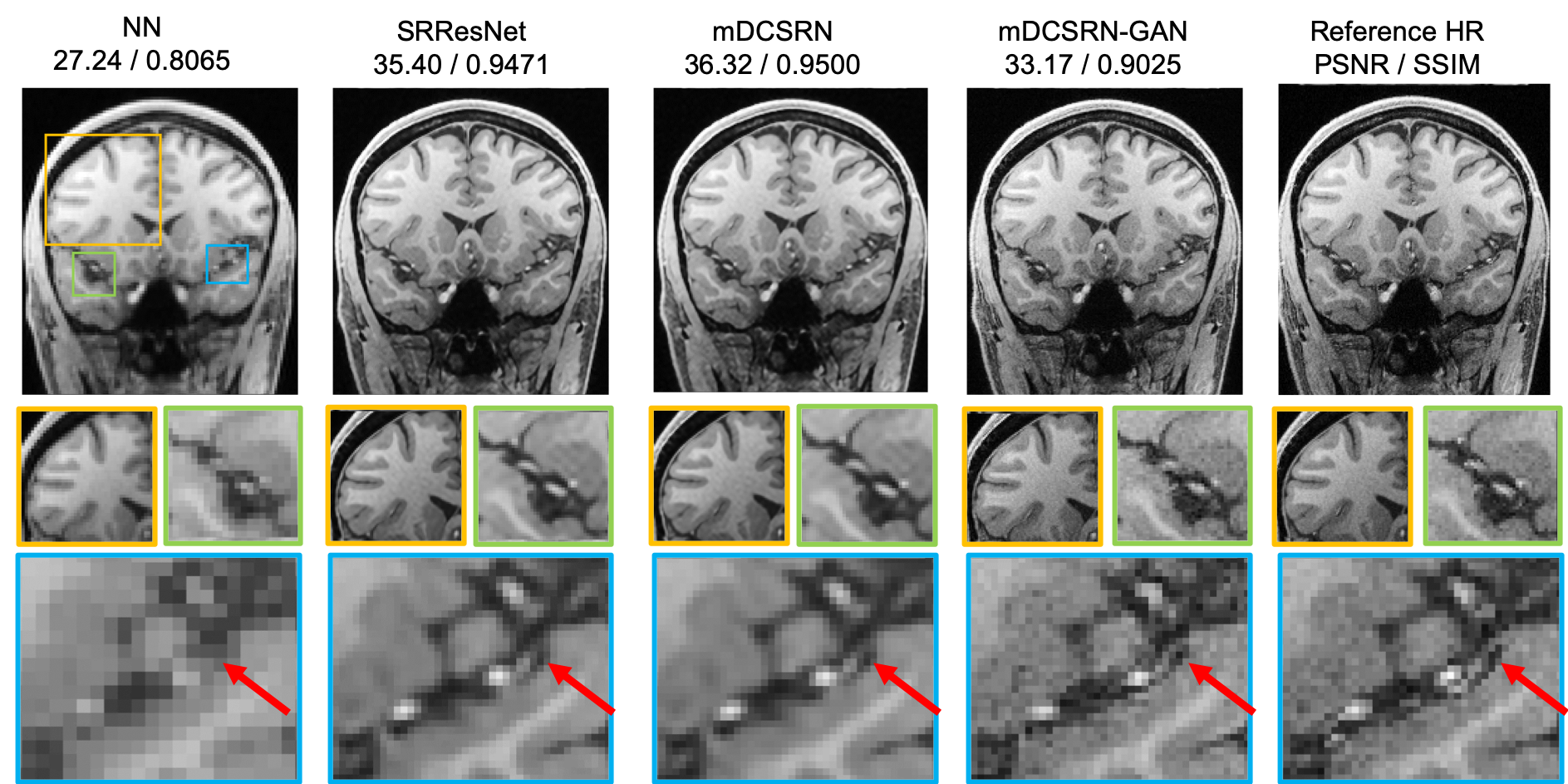 MRI Super-Resolution with GAN and 3D Multi-Level DenseNet: Smaller ...