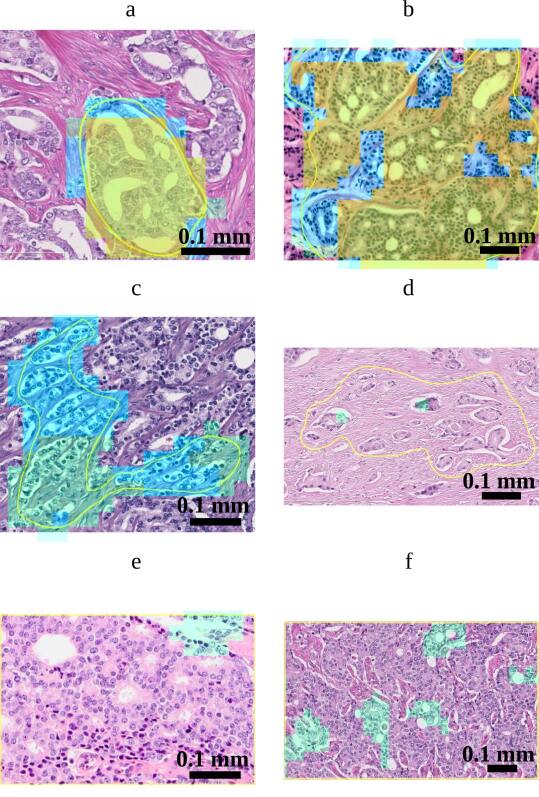 Automated Detection of Cribriform Growth Patterns in Prostate Histology ...