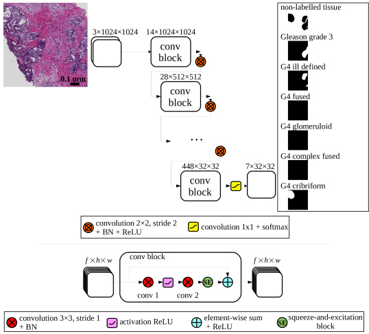 Automated Detection of Cribriform Growth Patterns in Prostate Histology ...