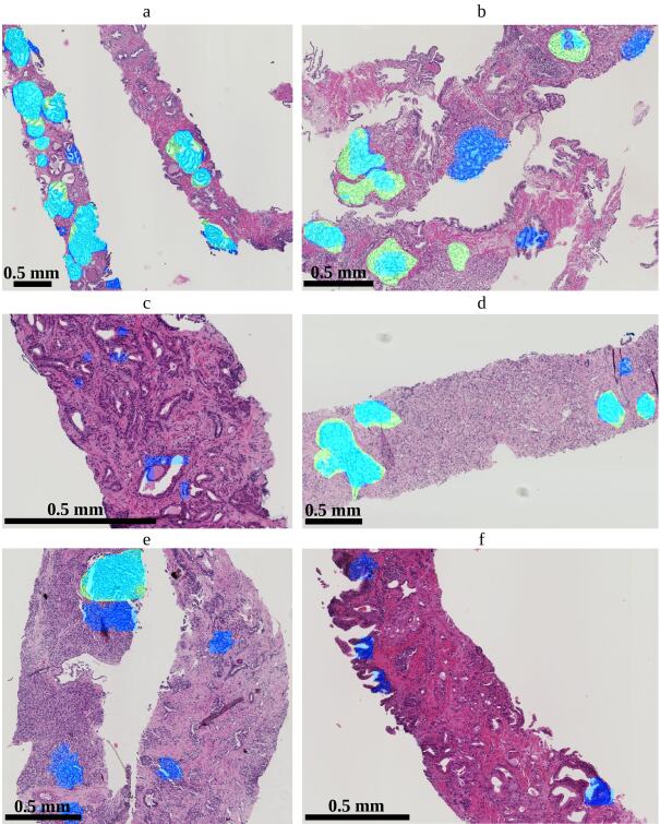 Automated Detection of Cribriform Growth Patterns in Prostate Histology ...