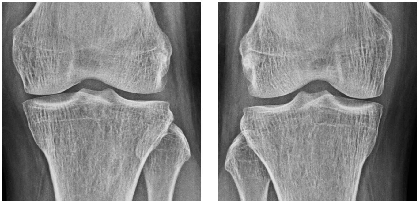 Automatic Grading of Knee Osteoarthritis on the Kellgren-Lawrence Scale ...