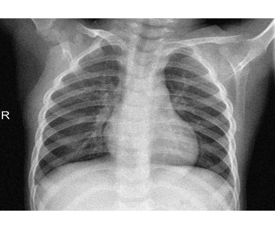 Classification of pediatric pneumonia using chest X-rays by functional ...