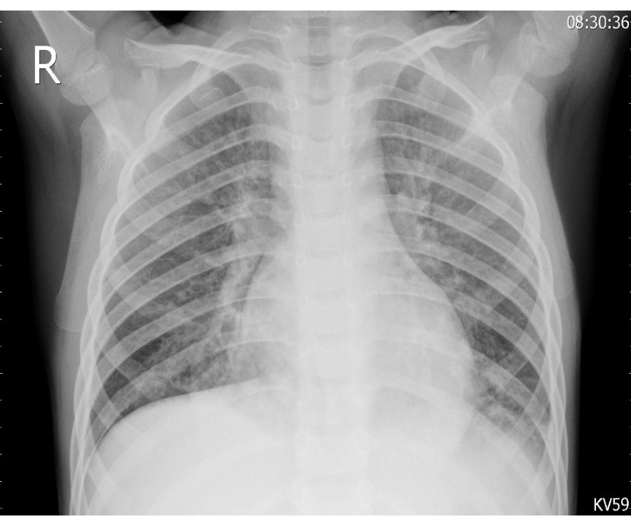 Classification of pediatric pneumonia using chest X-rays by functional ...