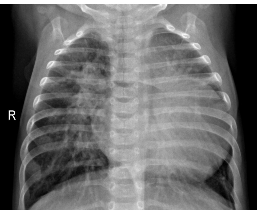 Classification of pediatric pneumonia using chest X-rays by functional ...