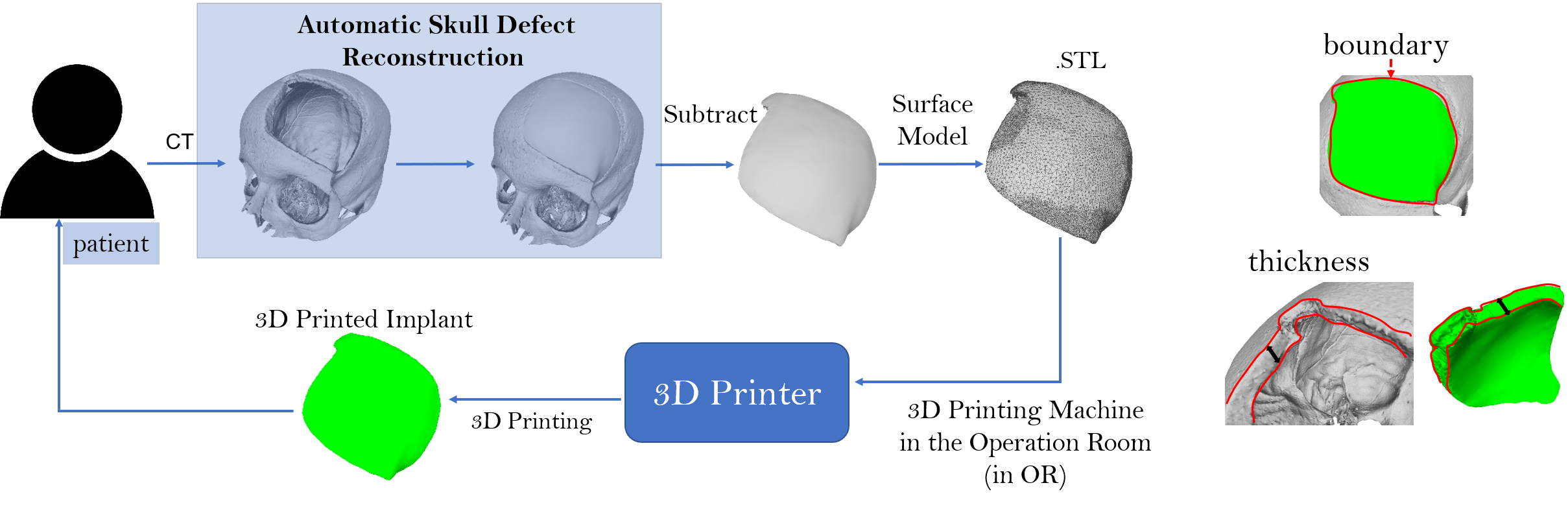 An Online Platform for Automatic Skull Defect Restoration and Cranial Implant Design | DeepAI
