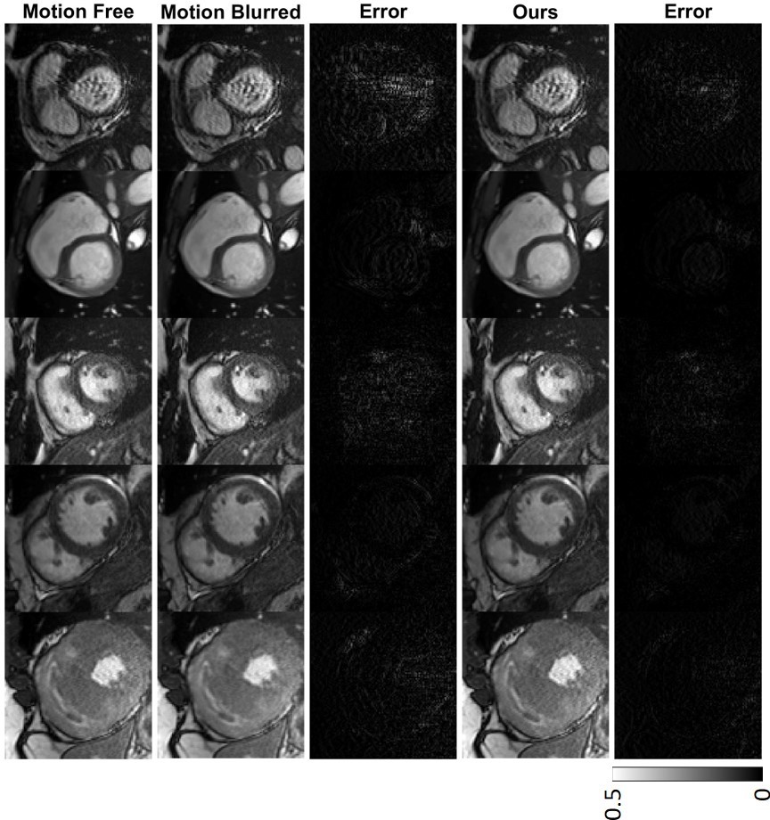 Cine Cardiac Mri Motion Artifact Reduction Using A Recurrent Neural Network Deepai