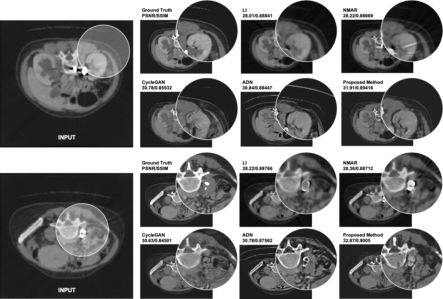 Unsupervised CT Metal Artifact Learning using Attention-guided beta ...