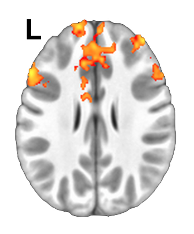 Visual Explanation for Identification of the Brain Bases for Dyslexia ...