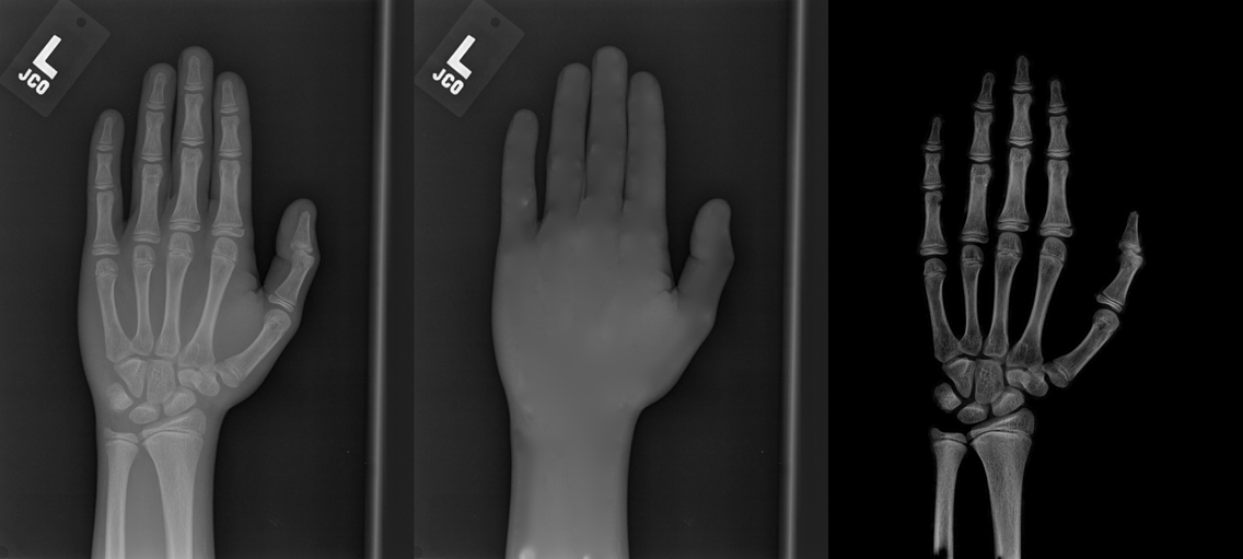 Decompose X-ray Images for Bone and Soft Tissue | DeepAI