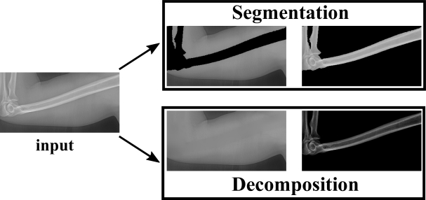 Decompose X-ray Images for Bone and Soft Tissue | DeepAI