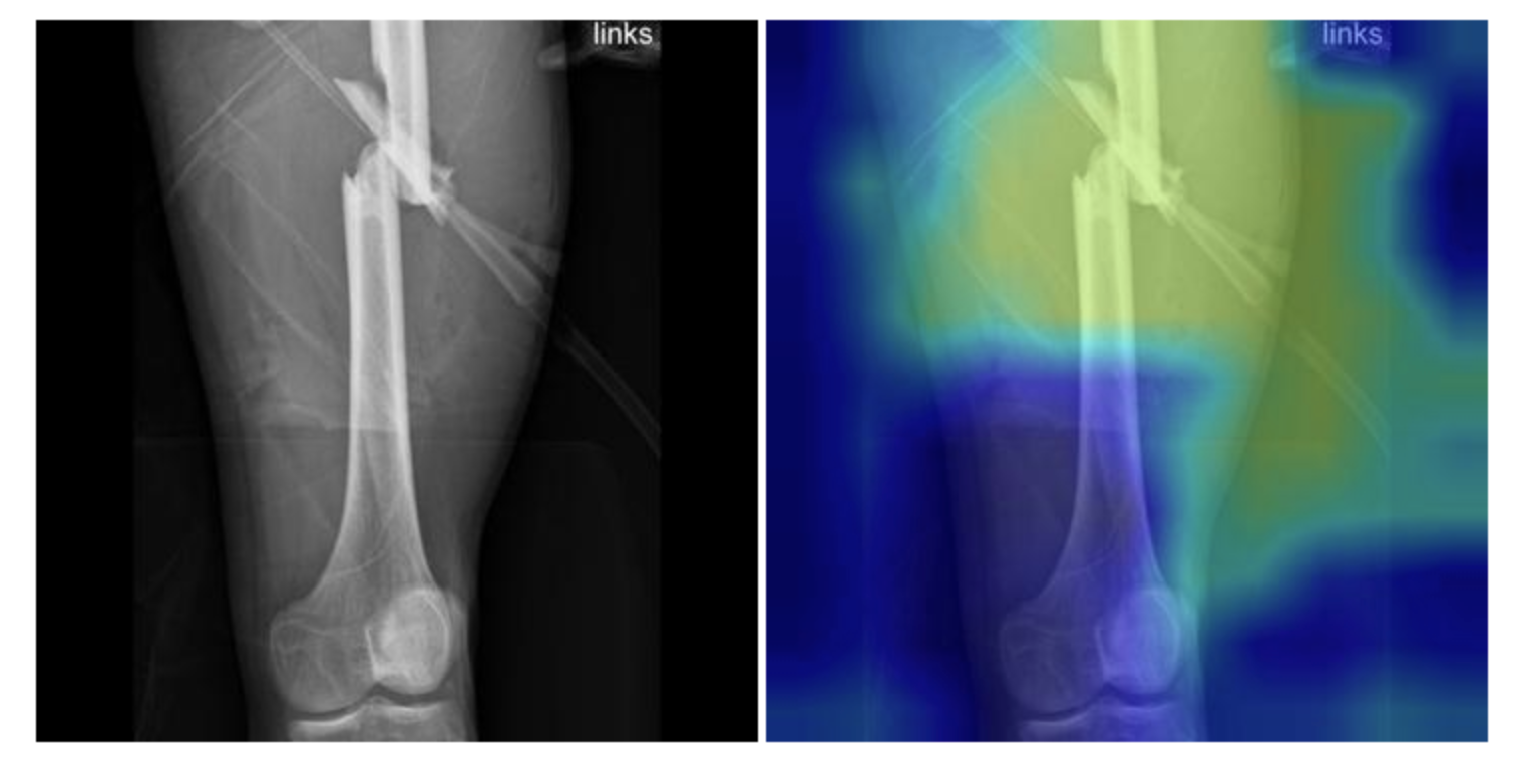 X Ray Bone Abnormalities Detection Using Mura Dataset Deepai