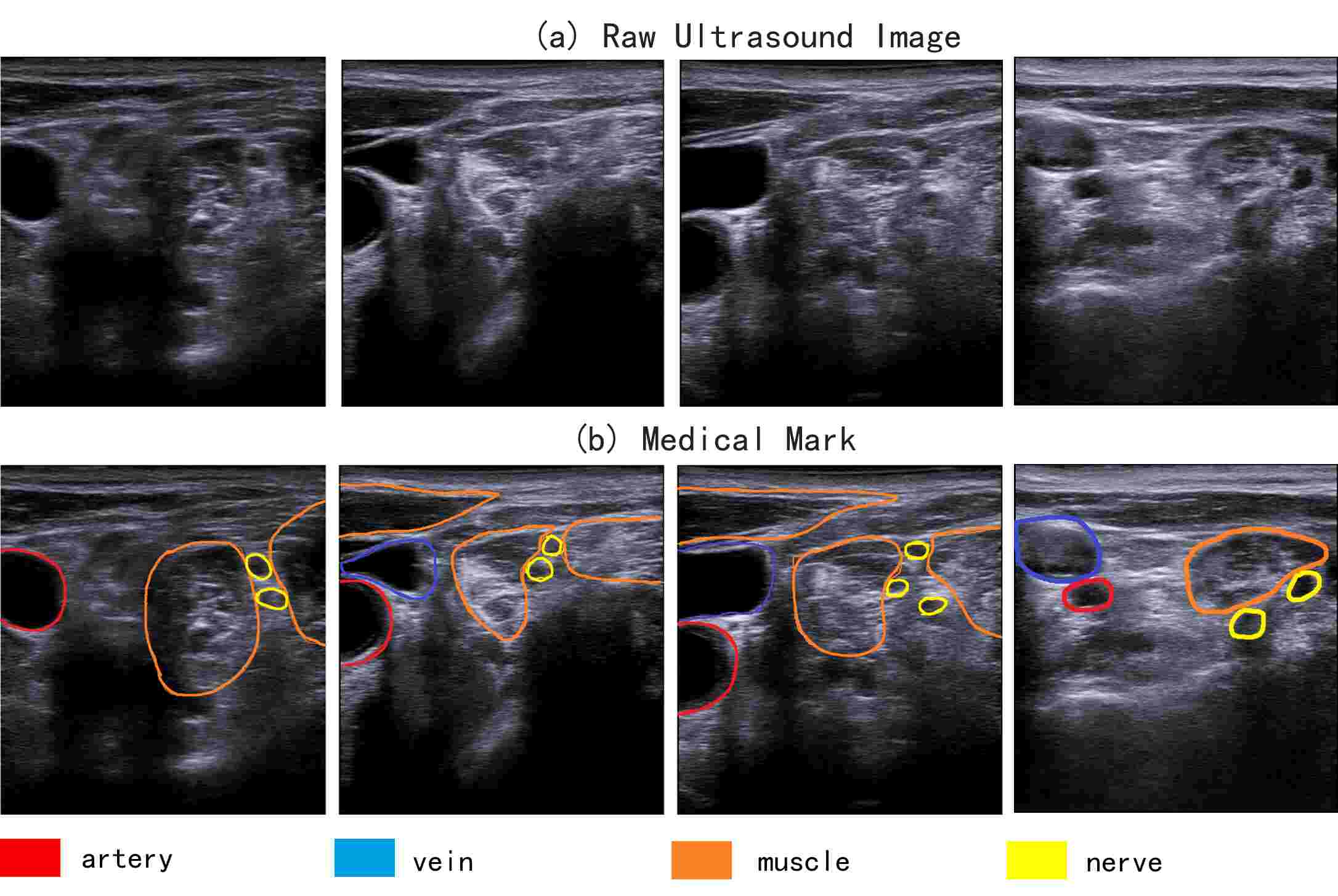 Multiple Instance Segmentation in Brachial Plexus Ultrasound Image Using BPMSegNet | DeepAI
