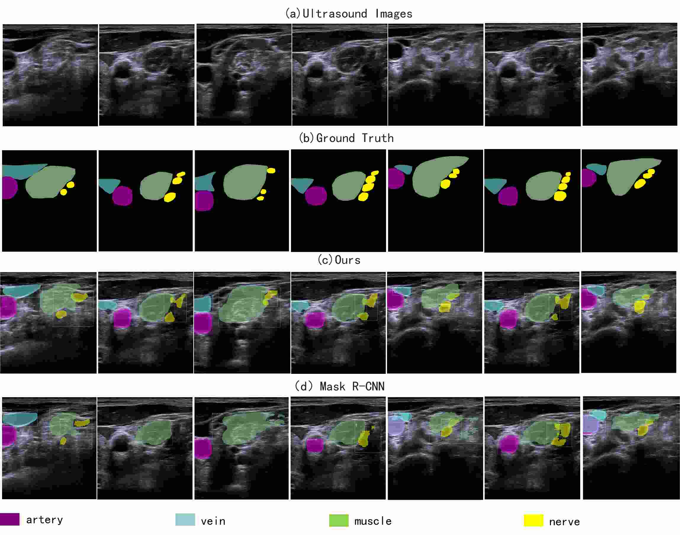 Multiple Instance Segmentation in Brachial Plexus Ultrasound Image Using BPMSegNet | DeepAI