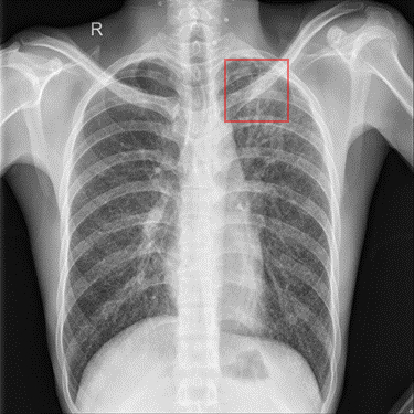 Deep Learning Methods for Screening Pulmonary Tuberculosis Using Chest ...