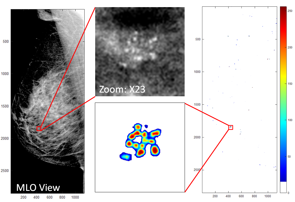 Segmenting Microcalcifications in Mammograms and its Applications | DeepAI