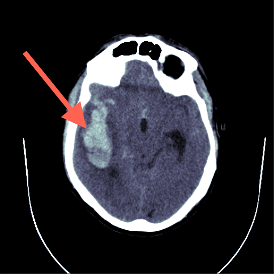 Unsupervised Acute Intracranial Hemorrhage Segmentation with Mixture ...