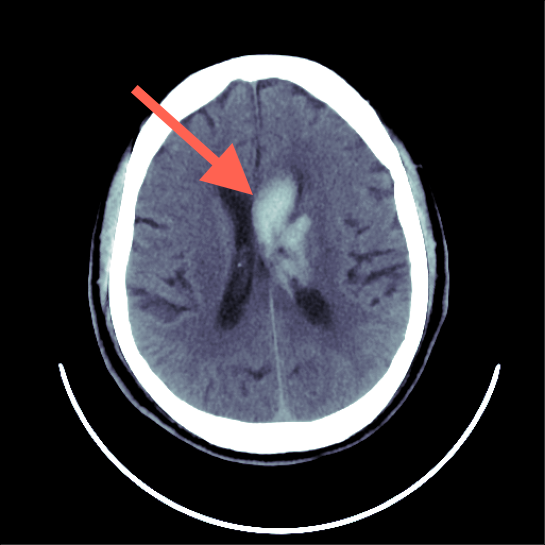 Unsupervised Acute Intracranial Hemorrhage Segmentation with Mixture ...