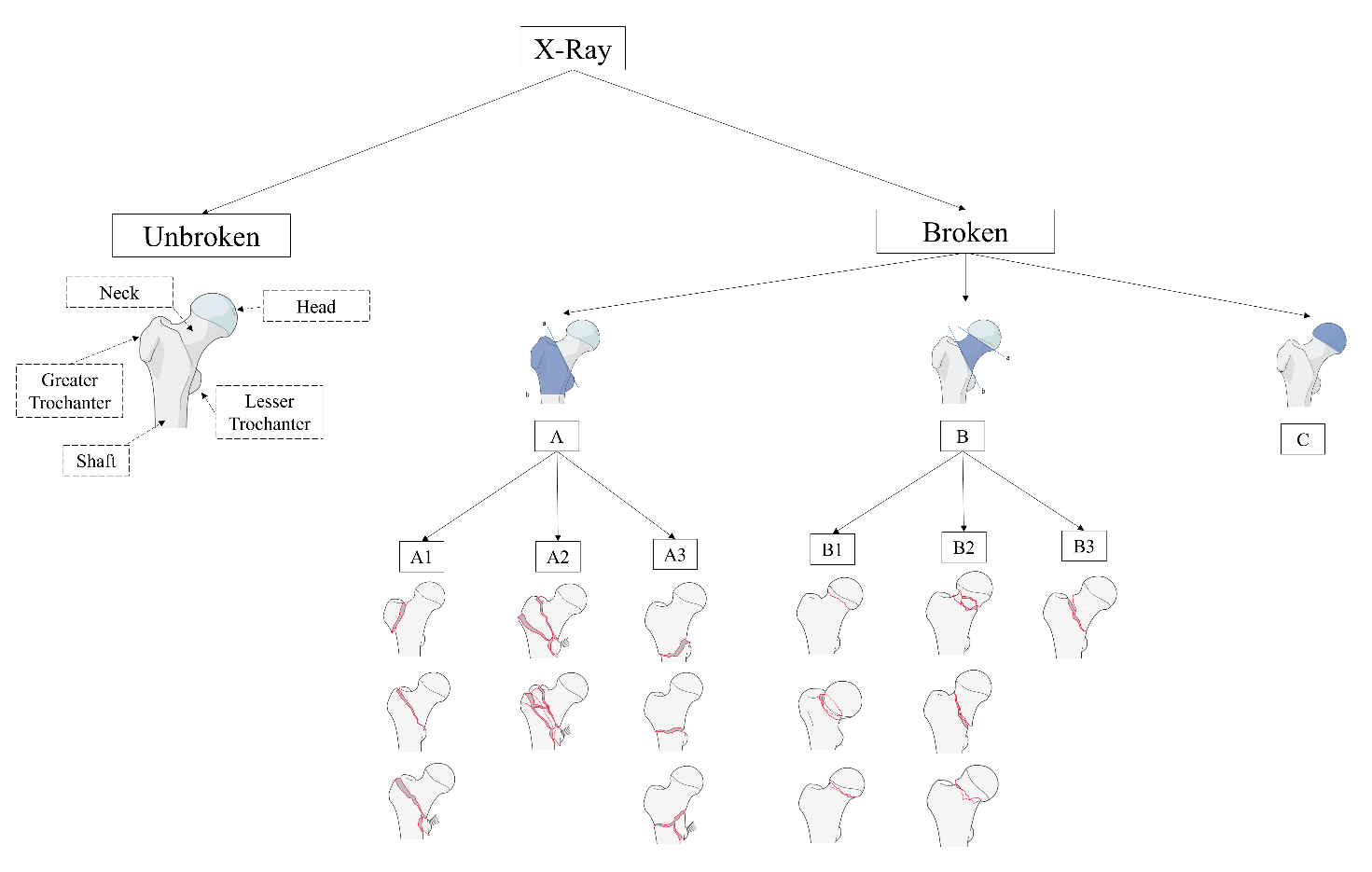 Vision Transformers for femur fracture classification | DeepAI
