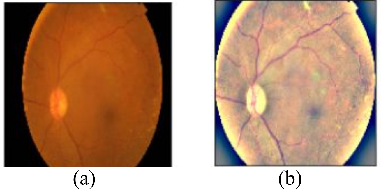 Blindness (Diabetic Retinopathy) Severity Scale Detection | DeepAI