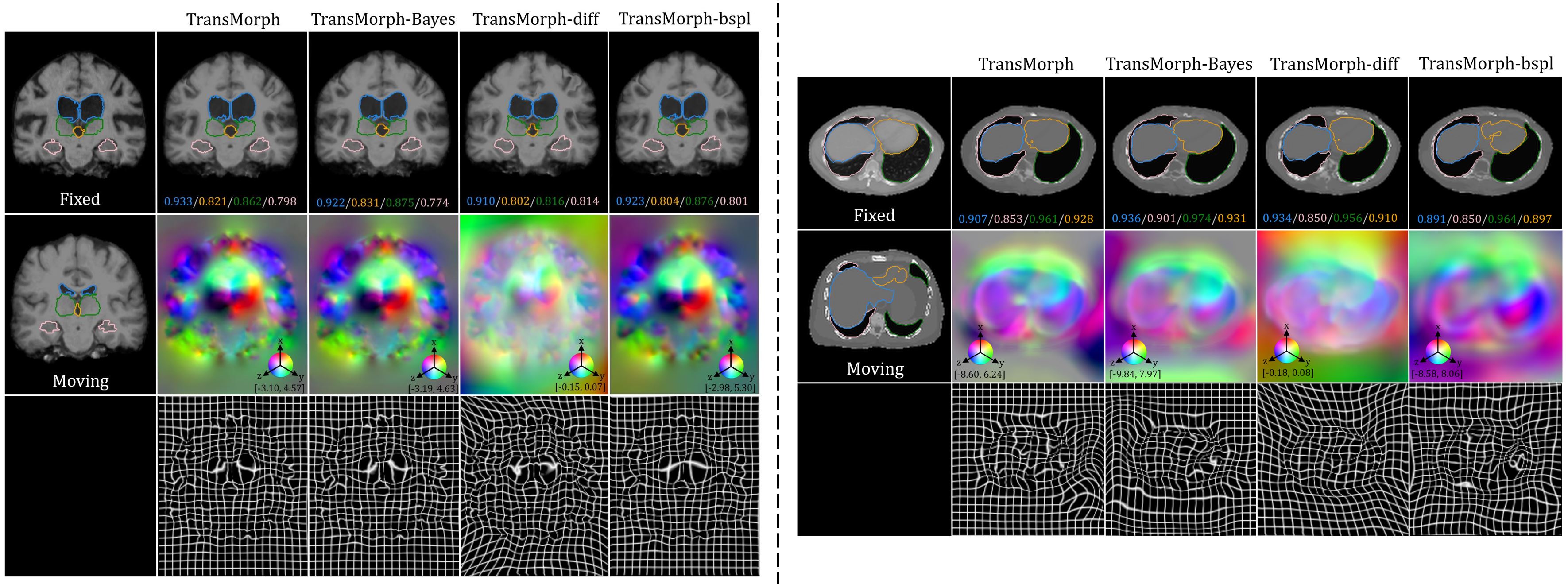 TransMorph: Transformer for unsupervised medical image registration ...