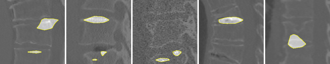 Interpretable Vertebral Fracture Diagnosis | DeepAI