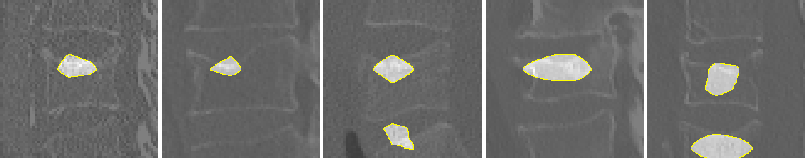 Interpretable Vertebral Fracture Diagnosis | DeepAI