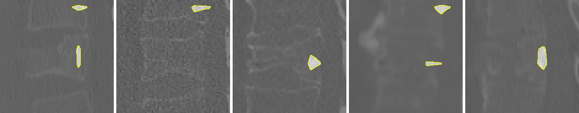 Interpretable Vertebral Fracture Diagnosis | DeepAI