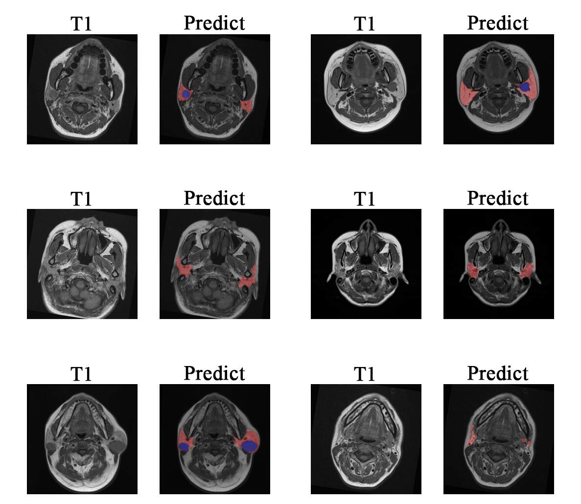 Parotid Gland MRI Segmentation Based on Swin-Unet and Multimodal Images ... Parotid Gland MRI Segmentation Based on Swin-Unet and Multimodal Images ...