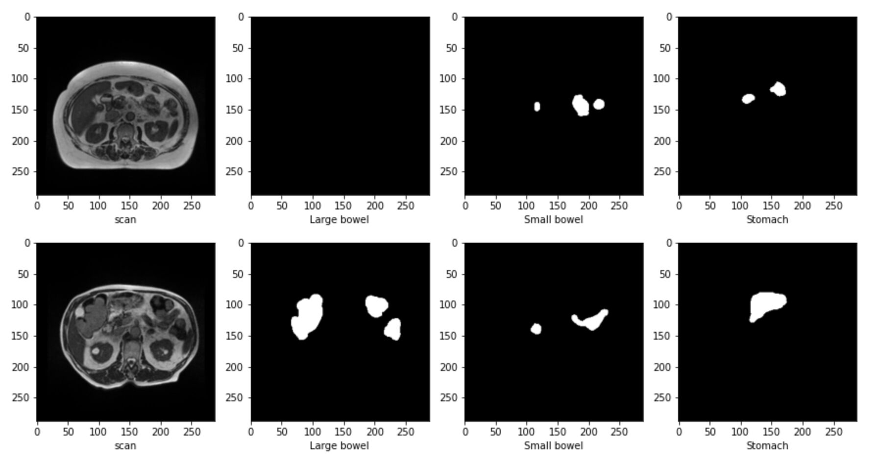 Automated GI tract segmentation using deep learning | DeepAI