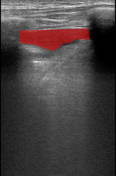 Deep Learning Based Segmentation Of Pleural Effusion From Ultrasound