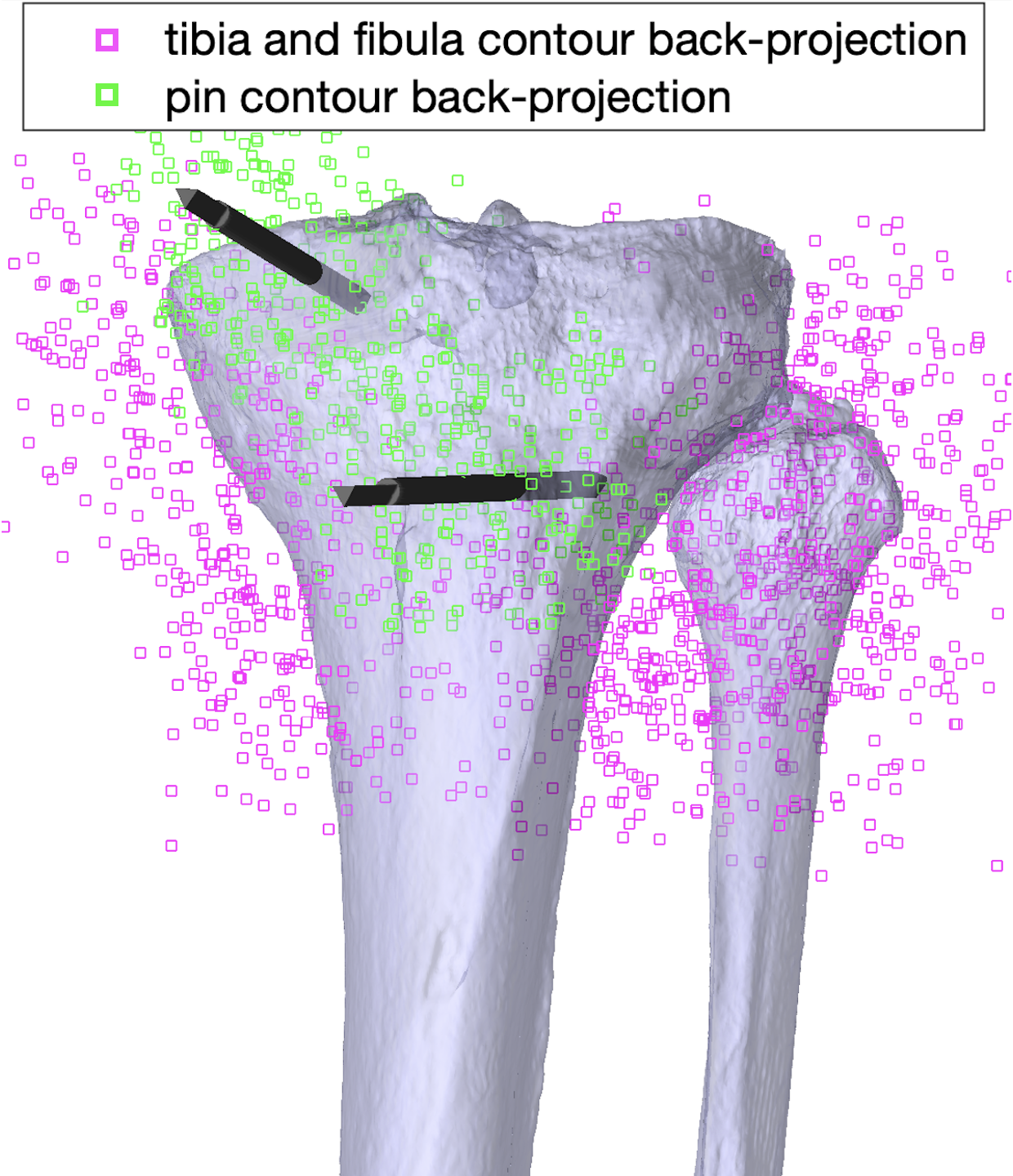 SLAM-TKA: Real-time Intra-operative Measurement of Tibial Resection ...