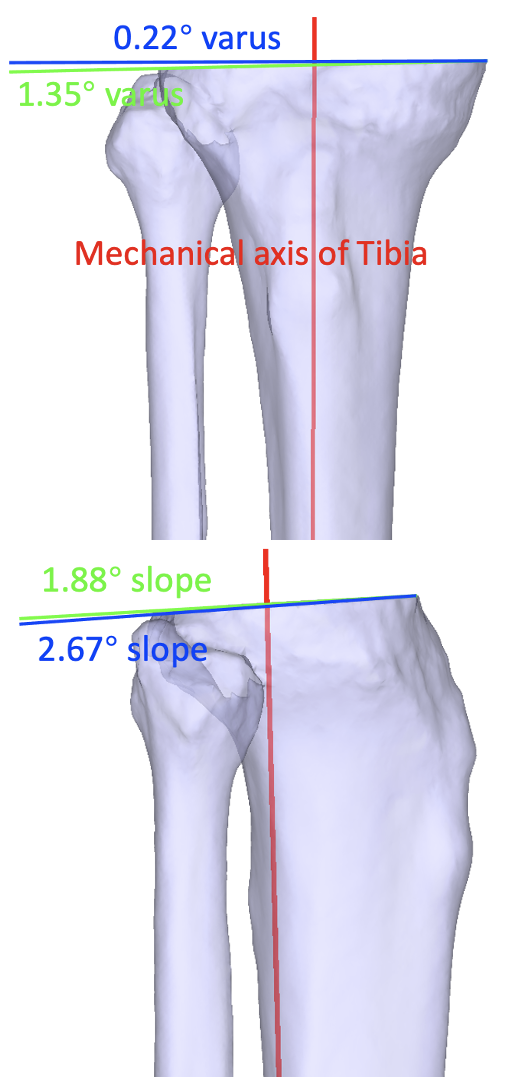 SLAM-TKA: Real-time Intra-operative Measurement of Tibial Resection ...