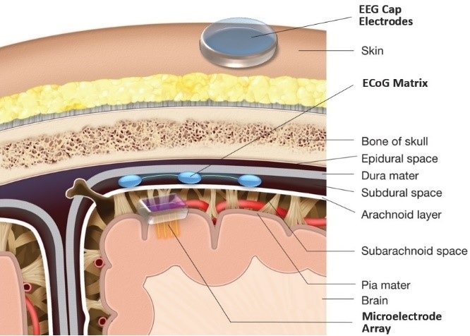 Zydeco-Style Spike Sorting Low Power VLSI Architecture for IoT BCI ...