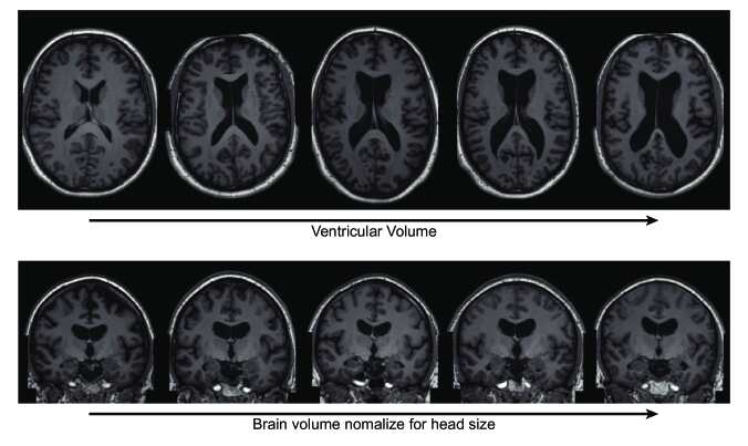 Brain Imaging Generation with Latent Diffusion Models | DeepAI