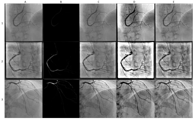 A Review of Modern Approaches for Coronary Angiography Imaging Analysis ...