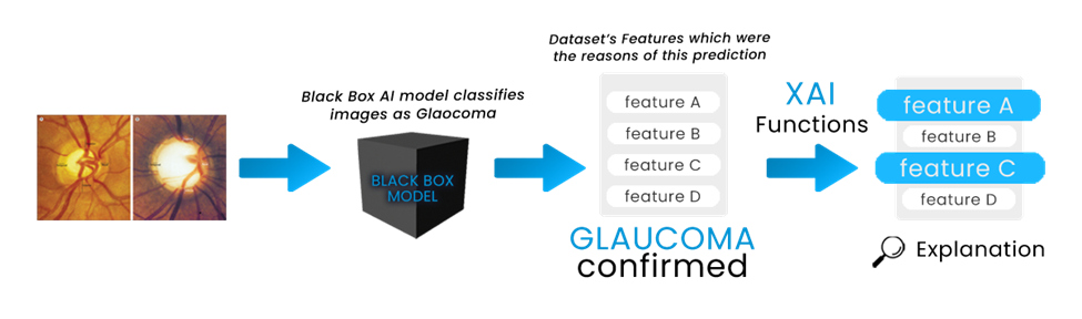 Explainable AI based Glaucoma Detection using Transfer Learning and ...